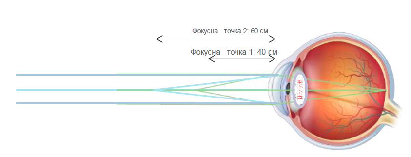 Medlens Optics: intraocular lenses from Alcon